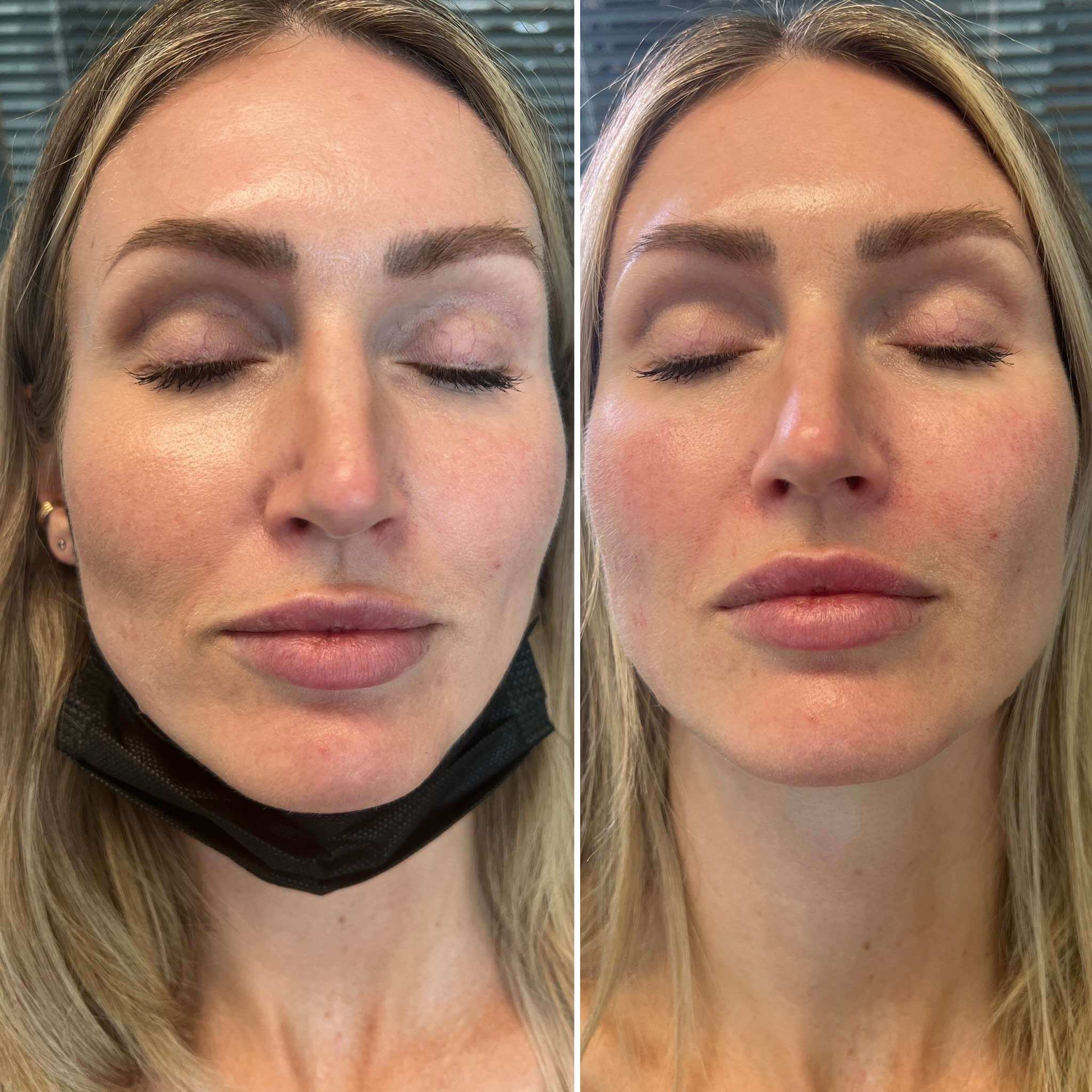 Dermal Fillers In Ottawa, ON | Skin Logic